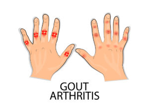 Systemic Arthritis: Understanding SJIA | Maggie Yu MD, IFMCP