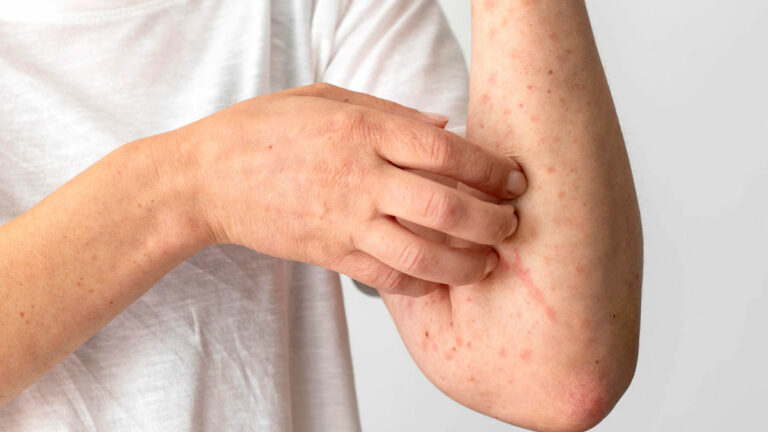 Liver Disease And Skin Rashes Key Symptoms And Treatments Maggie Yu Md