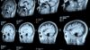 Acute Disseminated Encephalomyelitis (ADEM) vs Multiple Sclerosis (MS ...